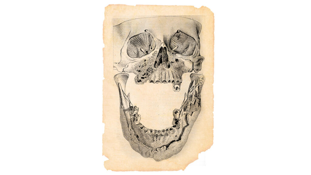 ‘Phossy jaw’ and a possible family connection - Irish Pharmacist