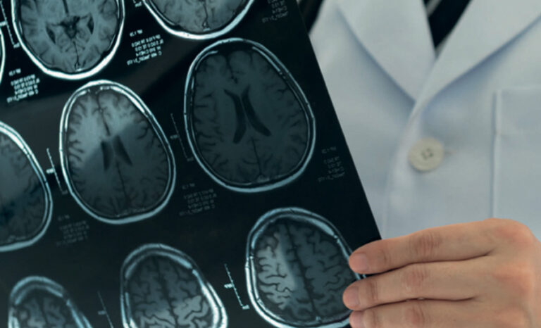 AI software tool aims to spot early signs of dementia from brain scans ...